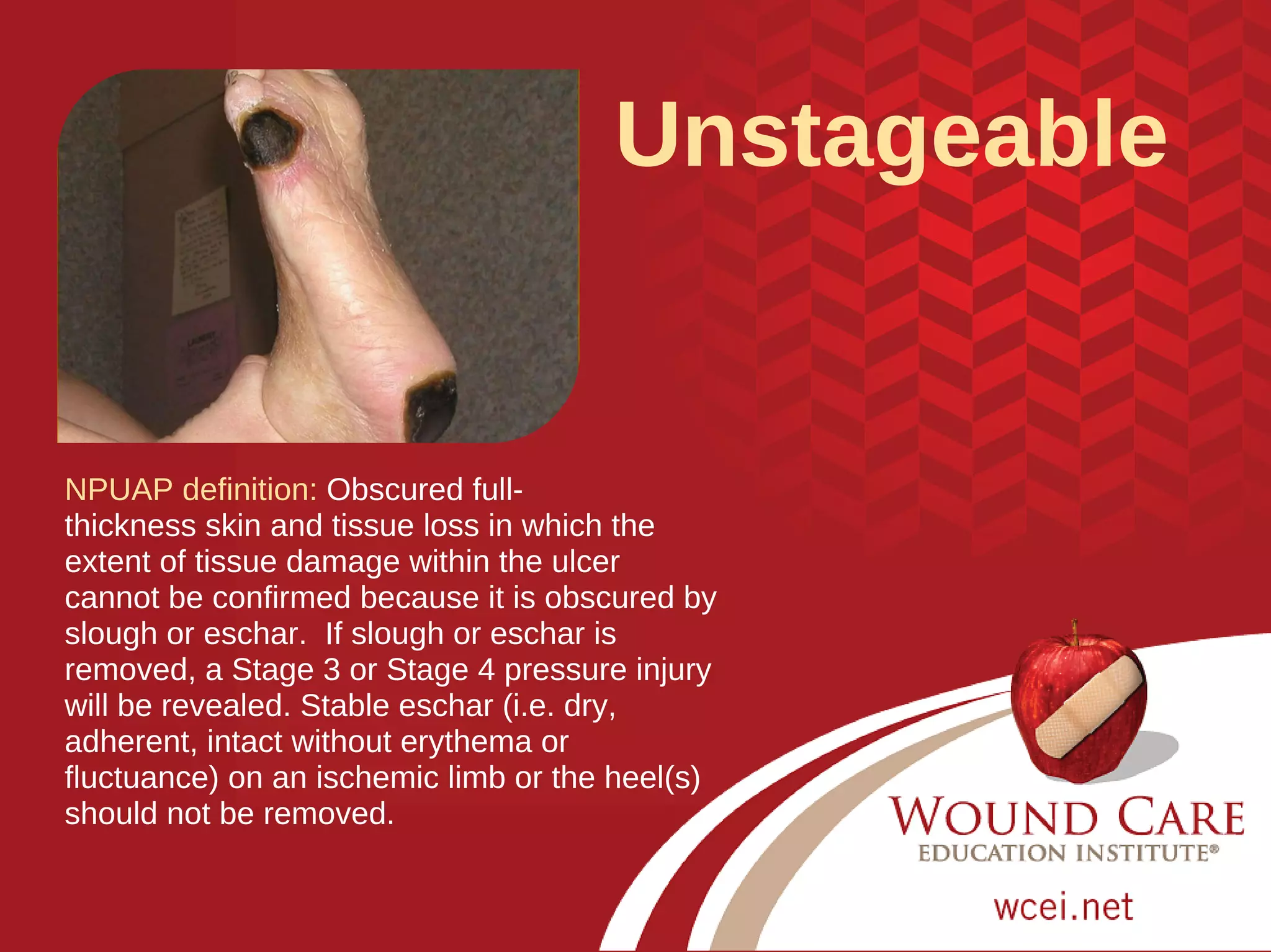 Test Your Pressure Injury Staging Skills - Updated for 2016 | PDF