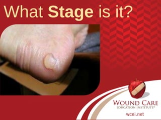 Test Your Pressure Injury Staging Skills - Updated for 2016 | PDF