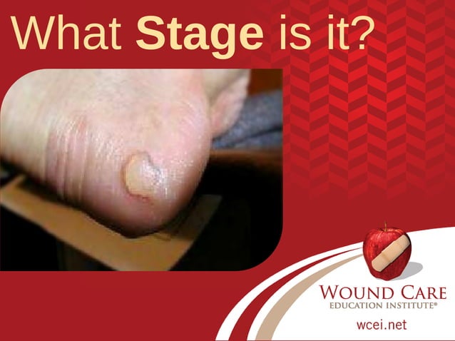 Test Your Pressure Injury Staging Skills - Updated for 2016 | PDF ...