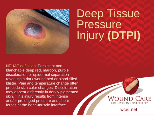 Test Your Pressure Injury Staging Skills - Updated for 2016 | PDF ...
