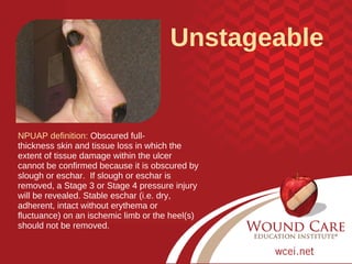 Test Your Pressure Injury Staging Skills - Updated for 2016 | PPT