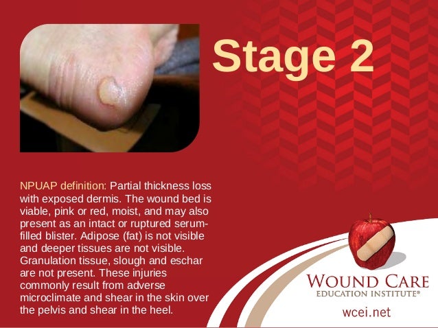 Test Your Pressure Injury Staging Skills - Updated for 2016