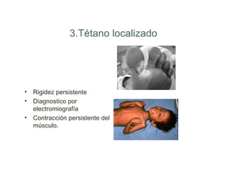 Tétano | PPT