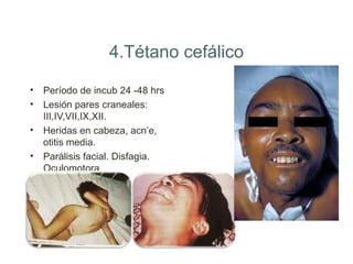 Tétano | PPT