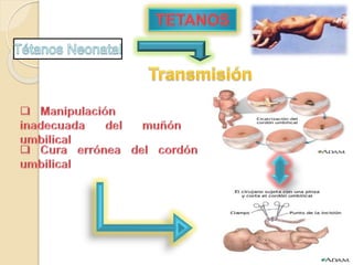 TETANO | PPTX