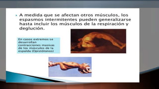 Tetano neonatal | PPTX