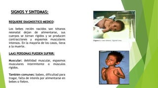 tetano neonatal. | PPTX