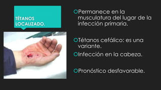 Tetanos | PPTX