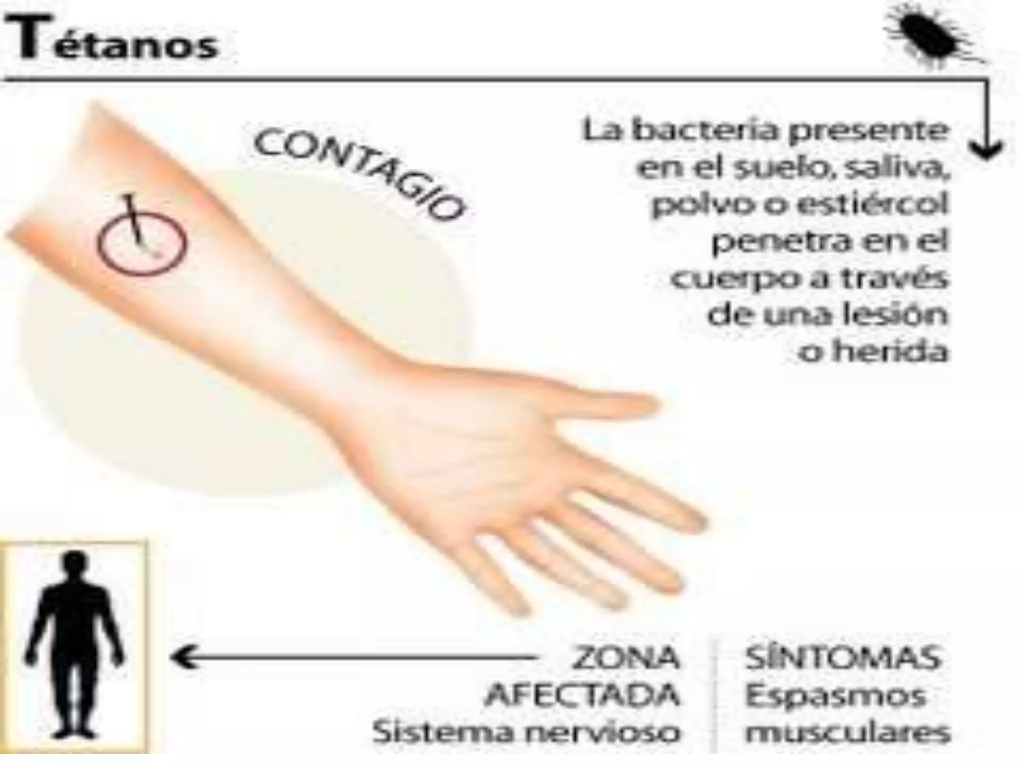 Tetanos resumen | PPT