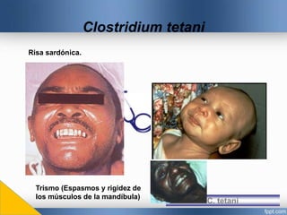 Tetano y botulismo | PPT