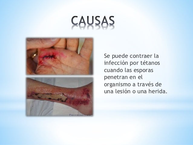 Tetano y tetano neonatal