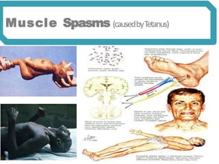 Tetanus | PPT
