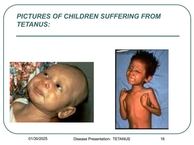 tetanus clinical features investigation treatment | PPTX