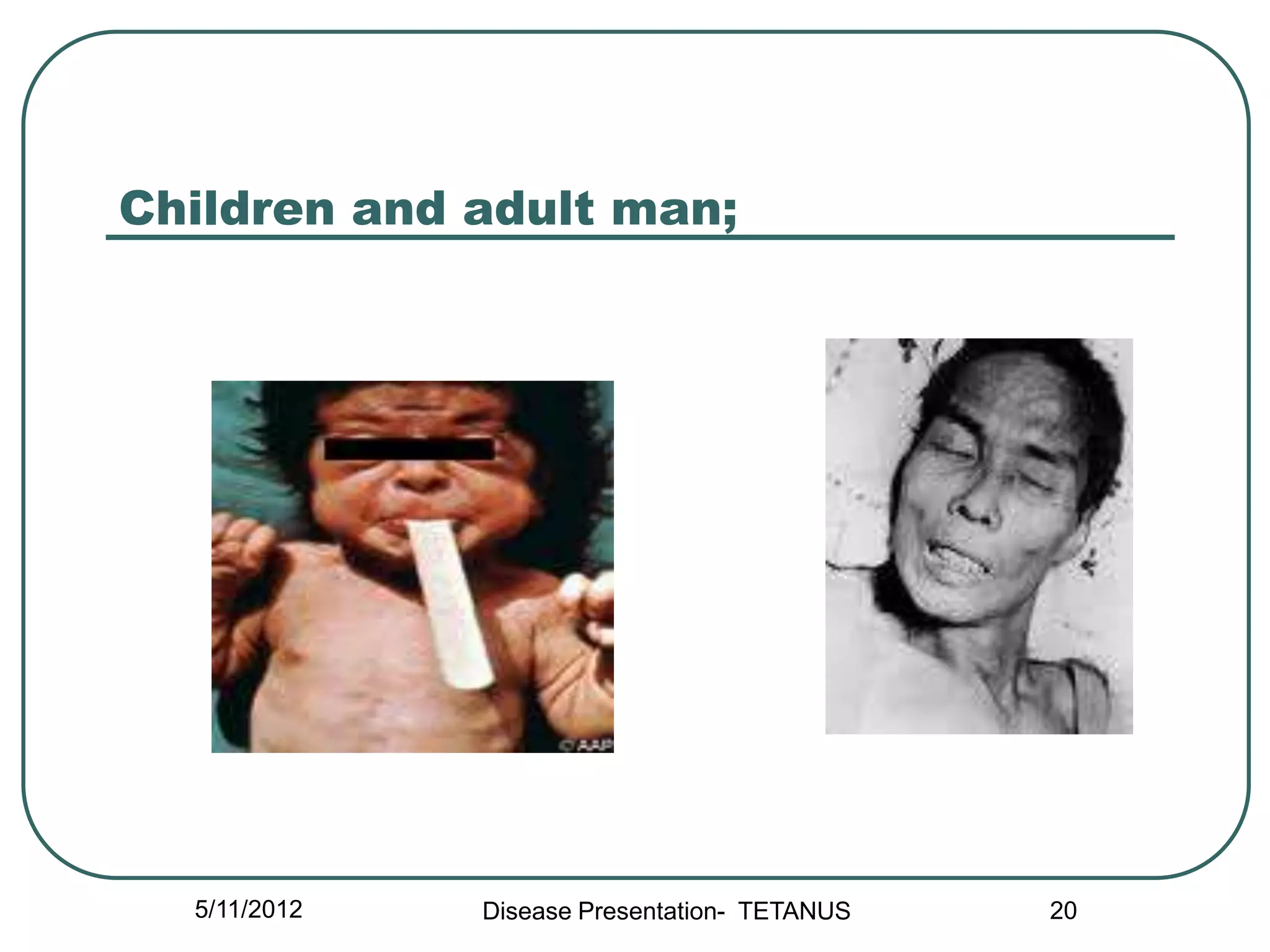 Tetanus | PPTX | Infectious Diseases | Diseases and Conditions