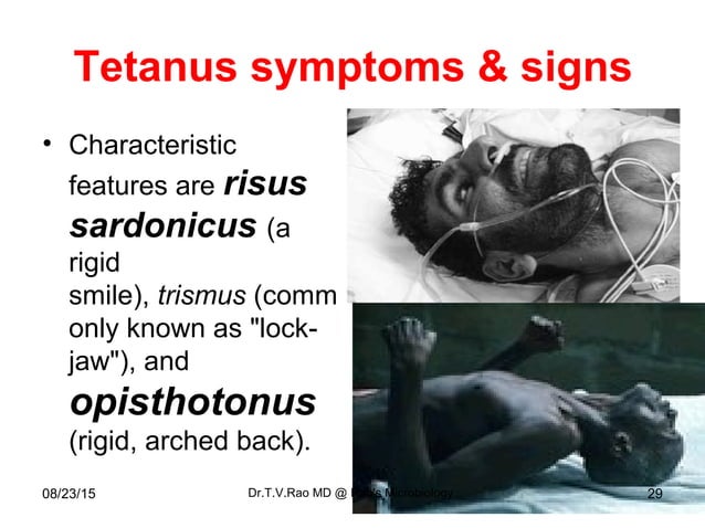 Tetanus Teaching basics | PPT