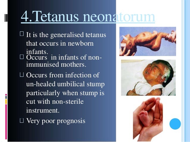 Tetanus