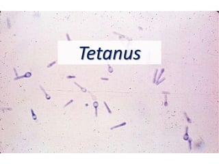 Tetanus | PPT