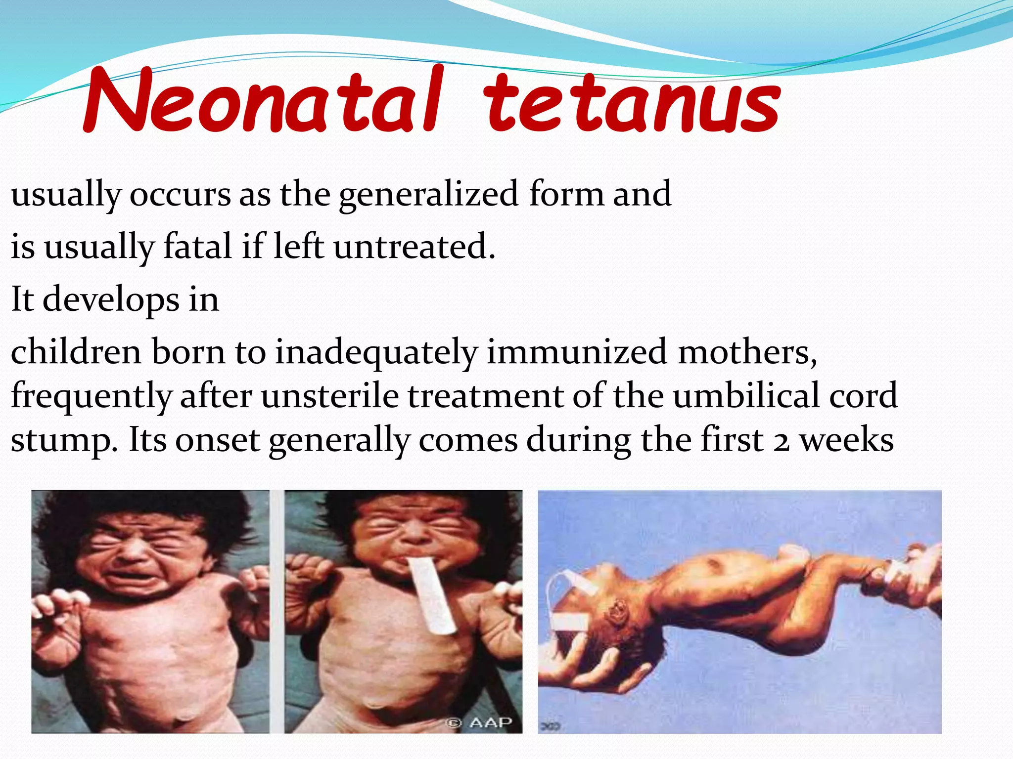 Tetanus | PPTX