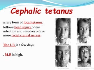 Tetanus | PPTX