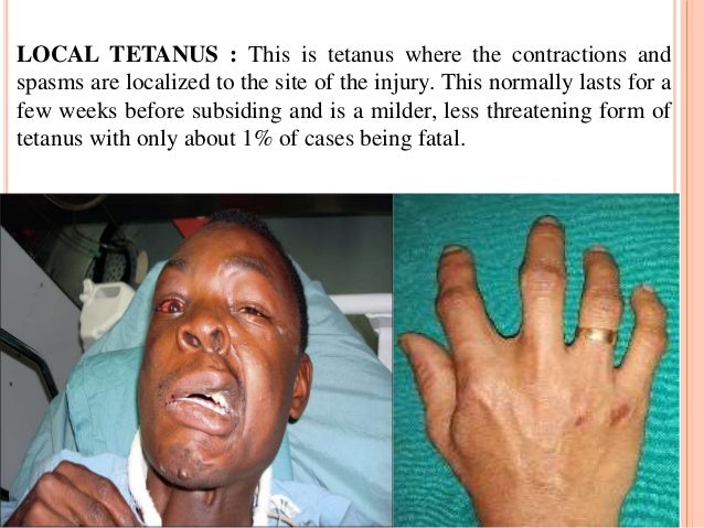 Tetanus also called: lockjaw