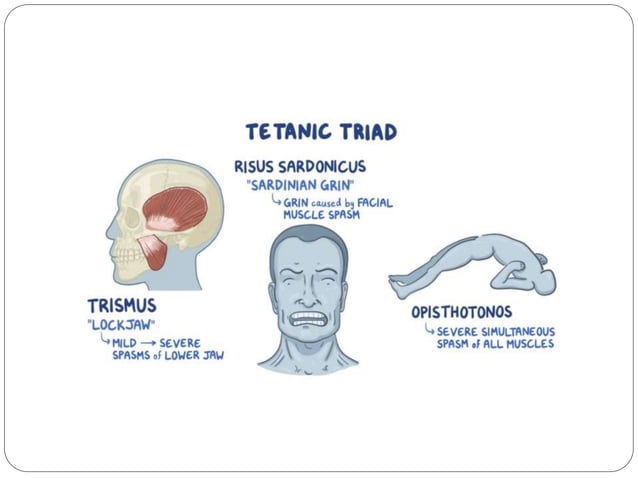 Tetanus | PPTX | Ear, Nose and Throat Conditions | Diseases and Conditions