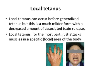 Tetanus | PDF