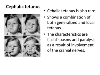 Tetanus | PDF