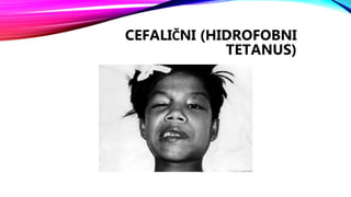 Tetanus - infektologija | PPTX