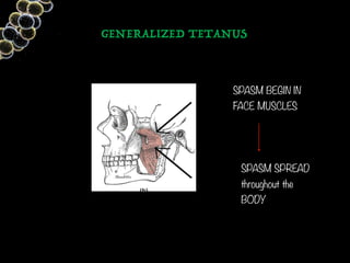 Tetanus | PDF