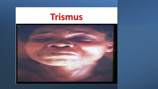 Tetanus.pptx
