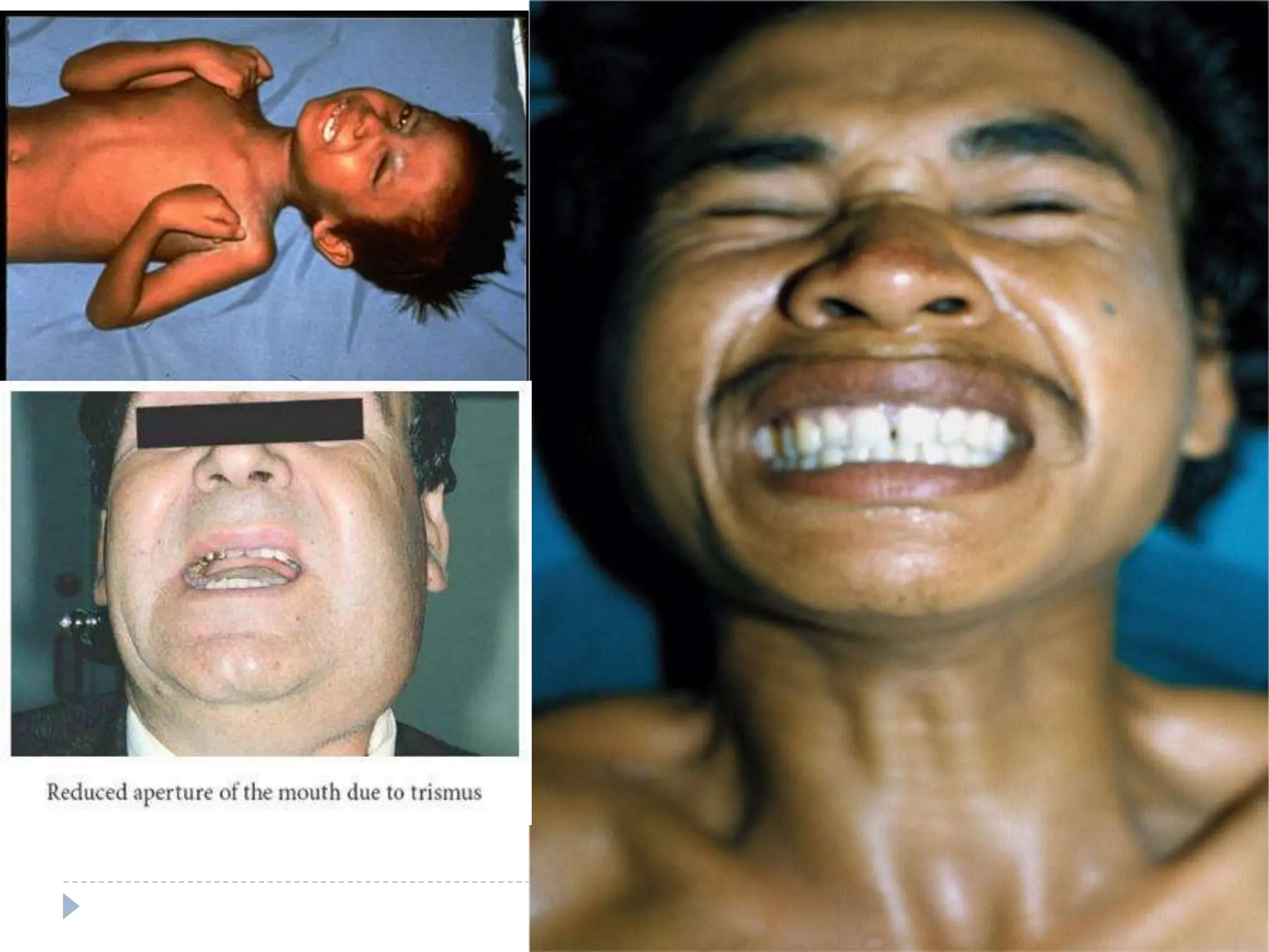 Tetanus Adult health nursing 3rd Semester | PPTX