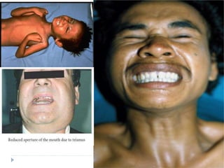 Tetanus Adult health nursing 3rd Semester | PPTX