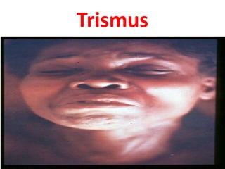 tetanus.pptx, introduction, pathophysiology | PPTX