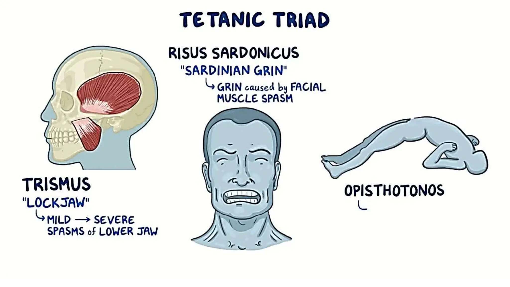 Tetanus: Pathogenesis, Epidemiology and Management | PPTX