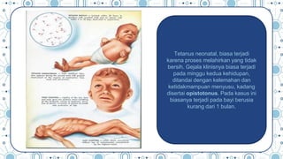 tetanus bedah aul.pptx
