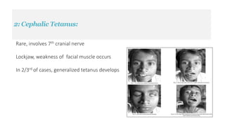 Tetanus | PPTX