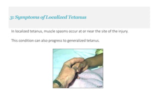 Tetanus | PPTX