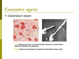 !Tetanus m | PPT