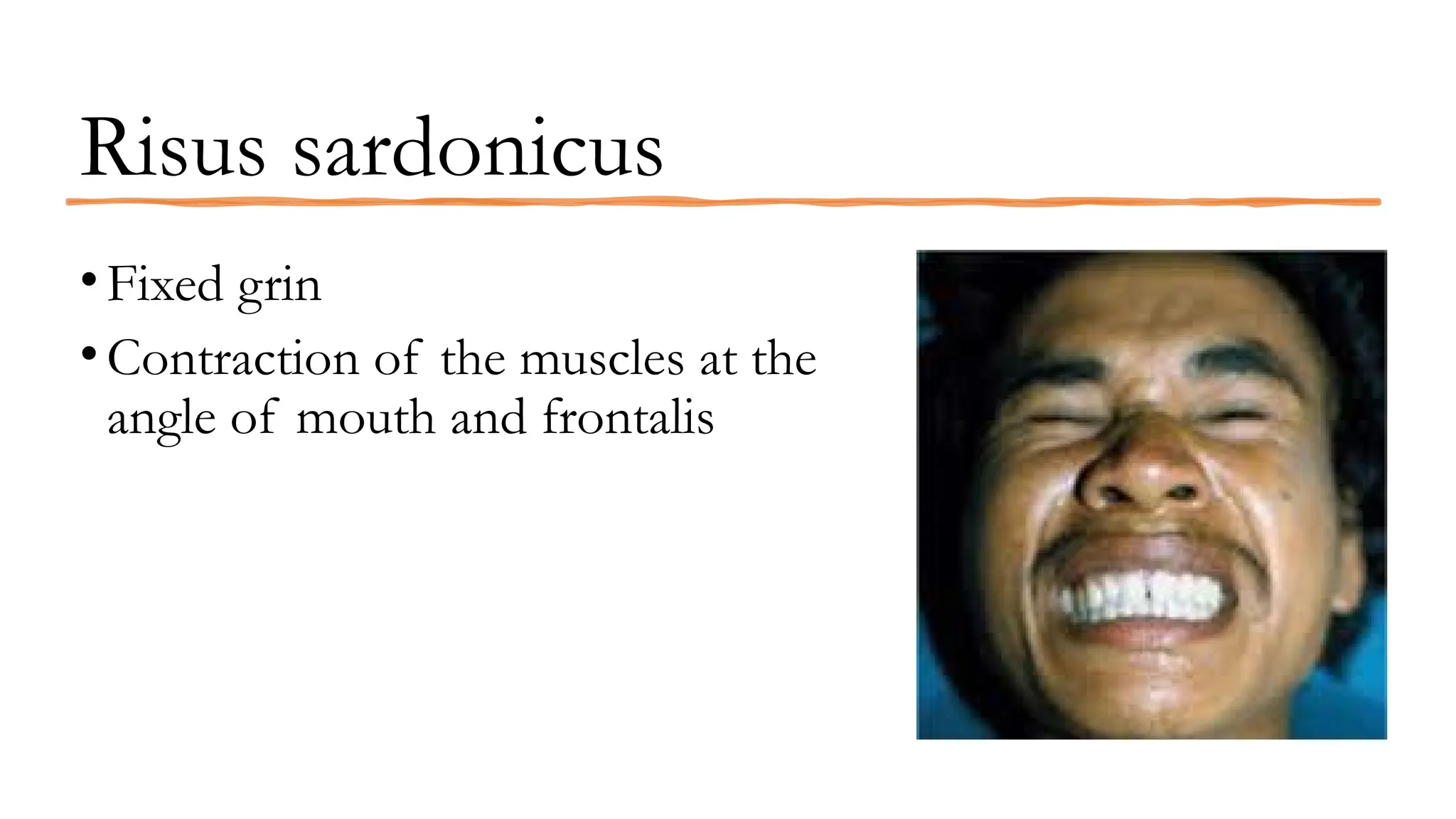 Definition And Principles Of Management Of Neonatal Tetanus Ppt
