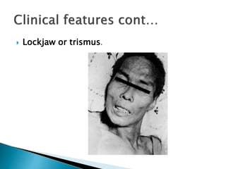 Tetanus prophylaxis and types of immunitynewnewv | PPTX