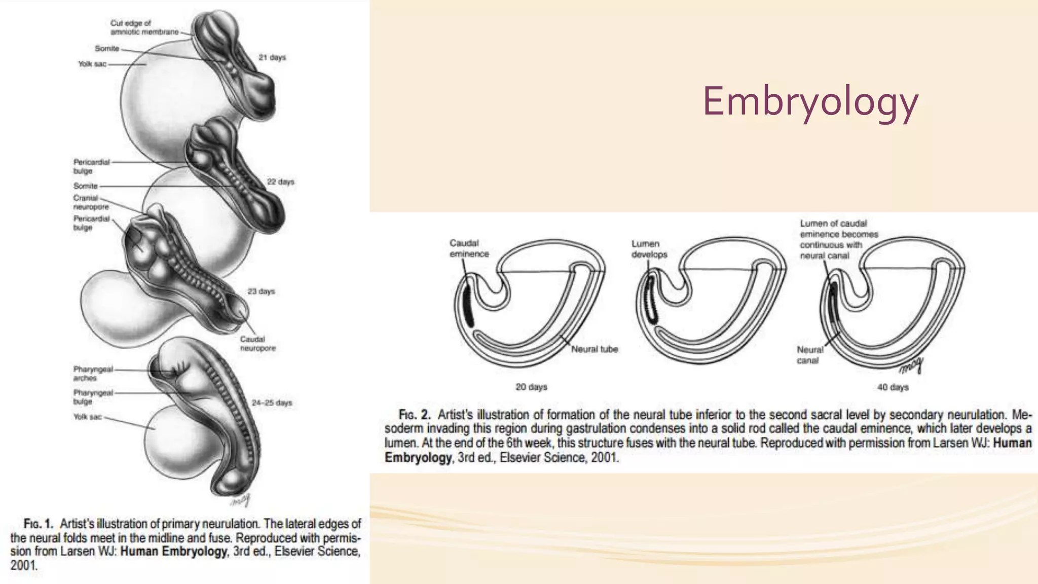 Tethered Cord Syndrome | PPTX