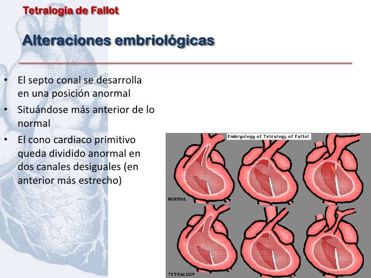 Tetralogía de Fallot