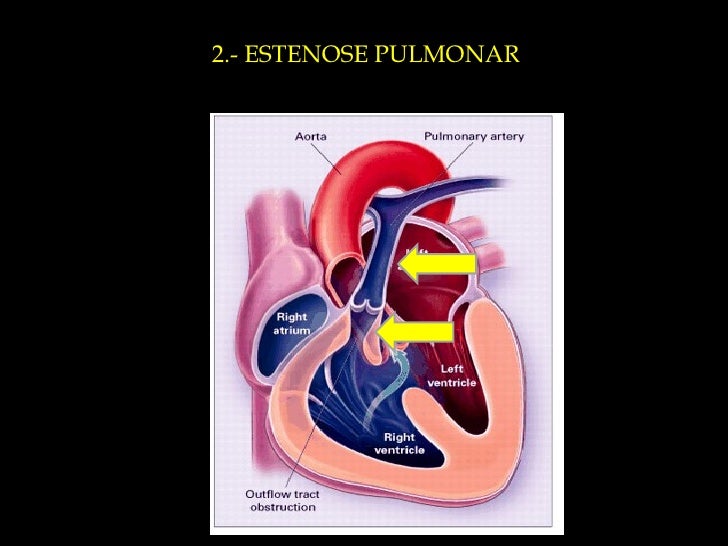Tetralogia de Fallot (T4F)