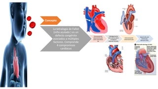Tetralogia de falot | PPTX
