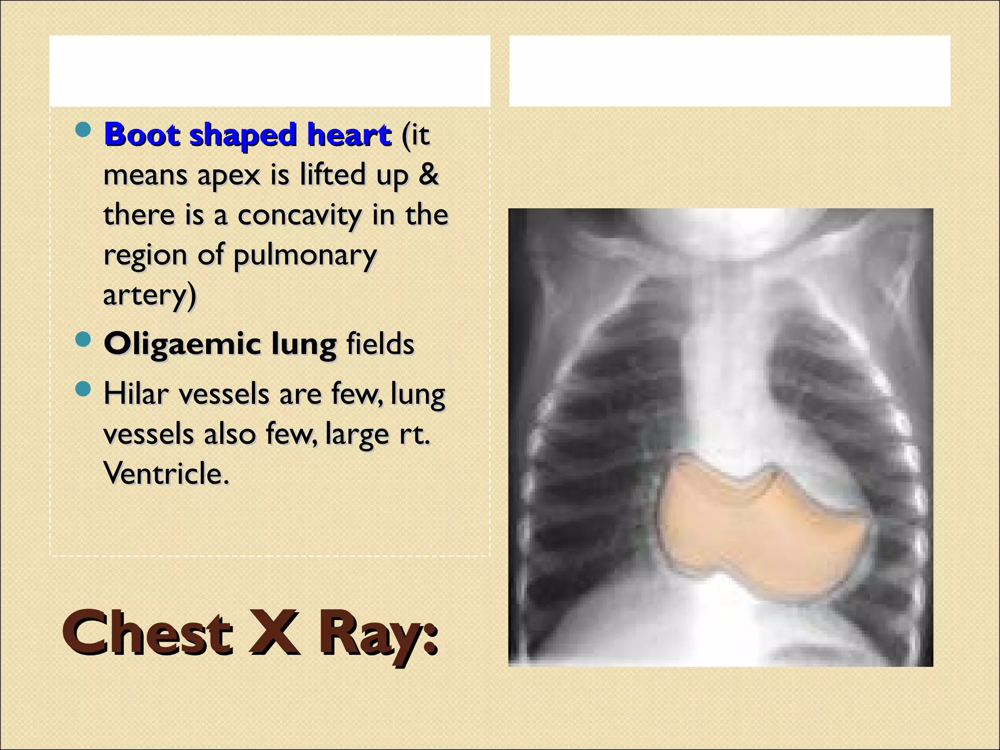 Tetralogy of fallot | PPT