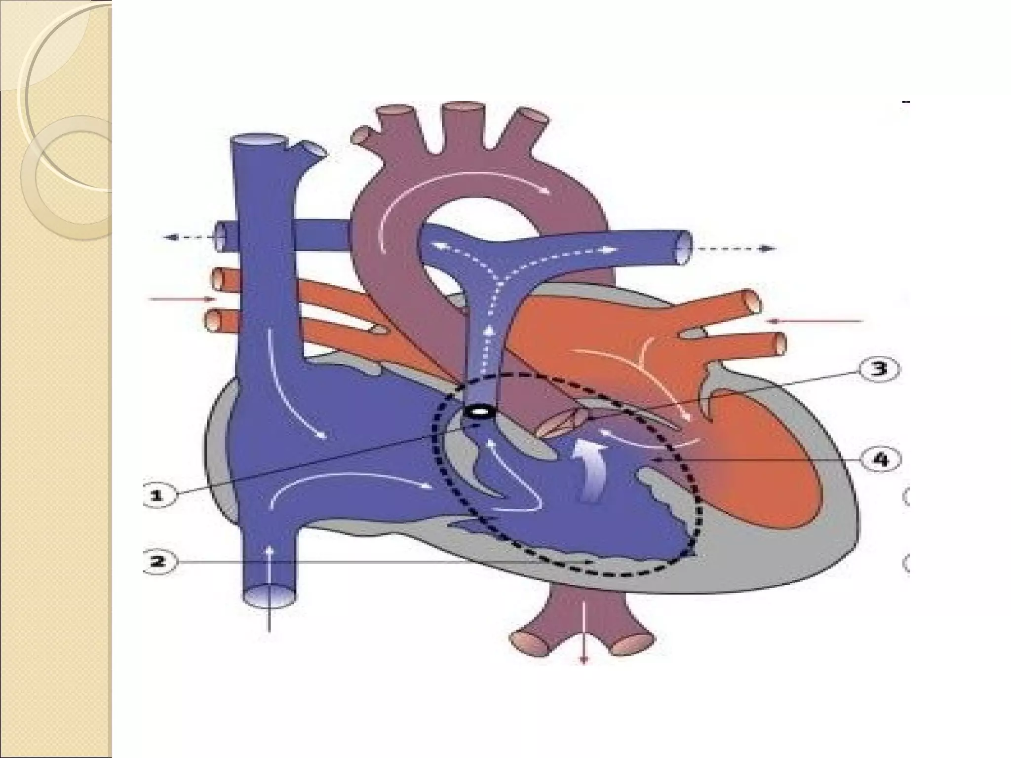 Tetralogy of fallot | PPT