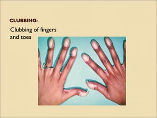 Tetralogy of fallot | PPT