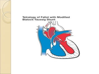 Tetralogy of fallot | PPT