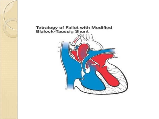 Tetralogy of fallot | PPT | Heart and Cardiovascular Diseases ...
