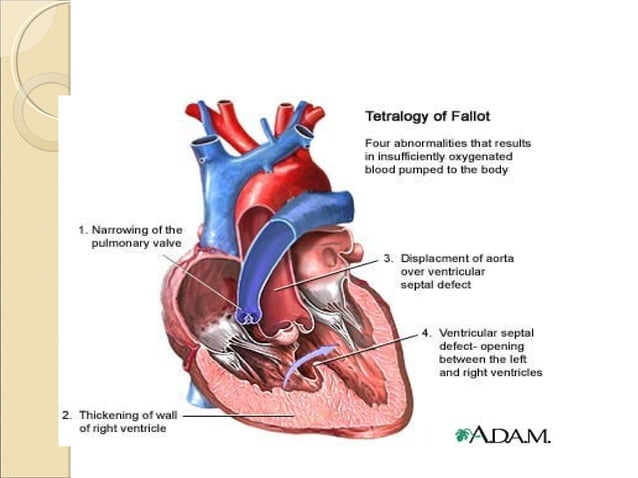 Tetralogy of fallot | PPT | Heart and Cardiovascular Diseases ...